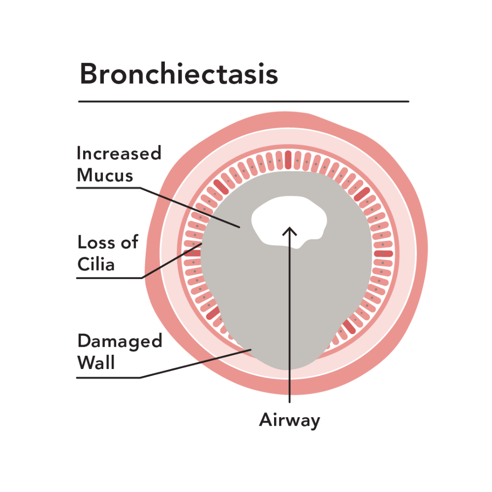 Airway Clearance - SmartVest Airway Clearance System